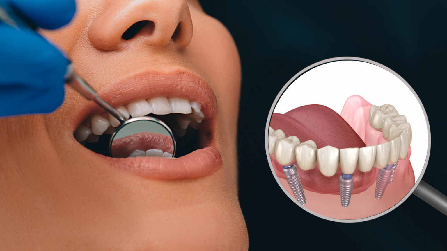Restore your natural-look smile with full arch Implants – Alexandria ...